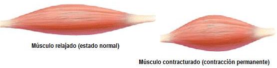 Tipos de Lesiones Musculares y su Tratamiento Específico