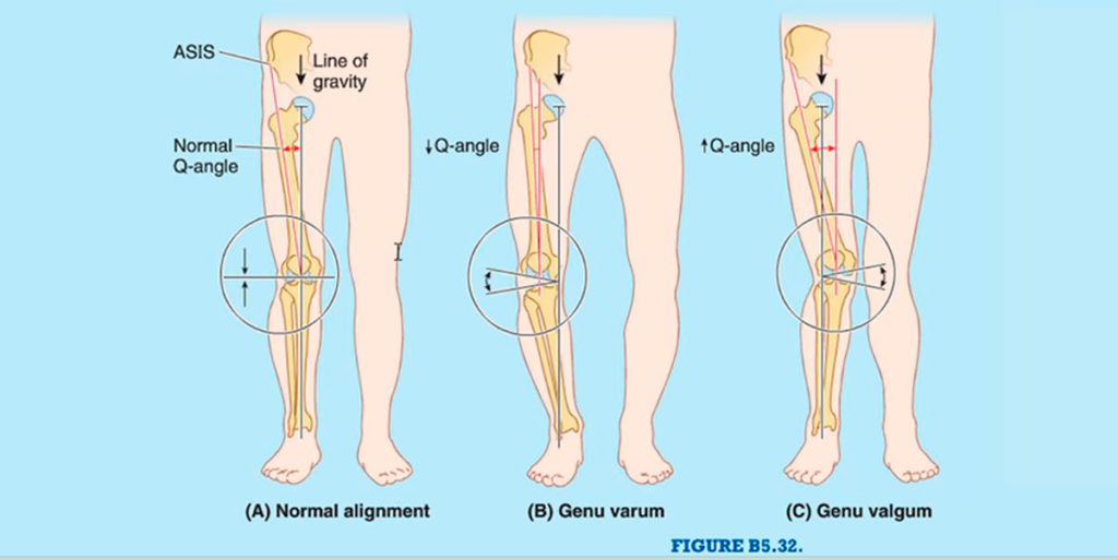Rodilla del Corredor: Síndrome cintilla iliotibial - HSN
