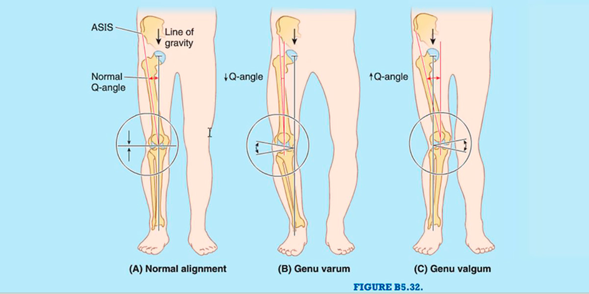 Rodilla del Corredor: Síndrome cintilla iliotibial - HSN
