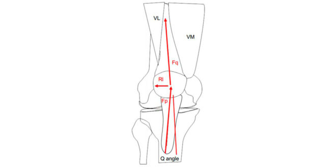 Rodilla del Corredor: Síndrome cintilla iliotibial - HSN